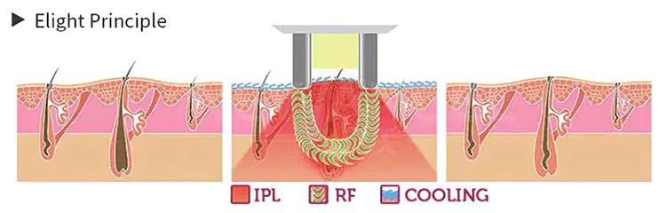 Best E light IPL RF Laser - Stelle Laser
